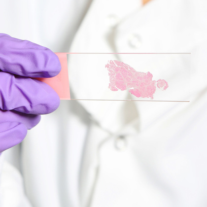 Nanoparticles developed at UTSW effectively fight tumors: Newsroom - UT ...