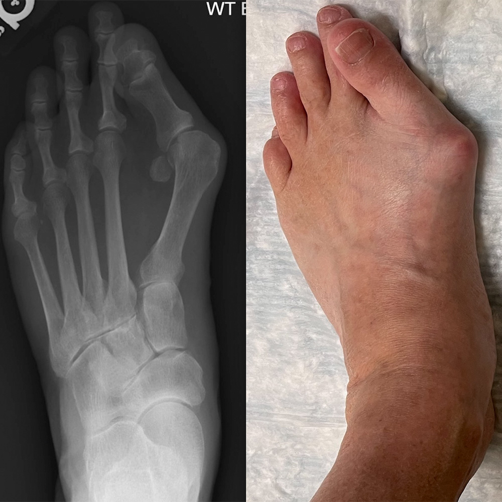 Bunion Surgery
